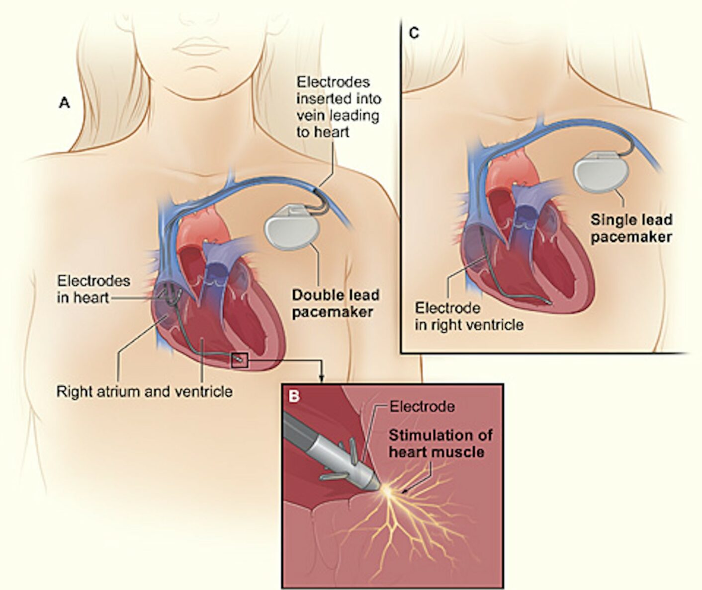 How do pacemakers and defibrillators work? A cardiologist explains how they interact with the ...